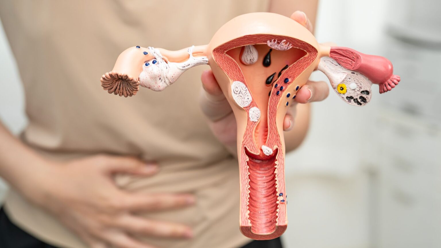 Adenomiose uterina: saiba tudo | Clínica Zucchi